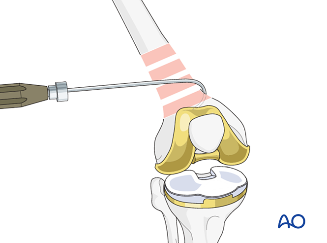 Retrograde nailing for Fracture proximal to the femoral component