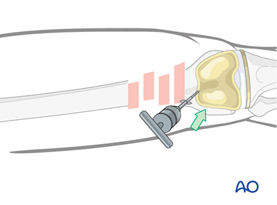 Retrograde nailing for Fracture proximal to the femoral component