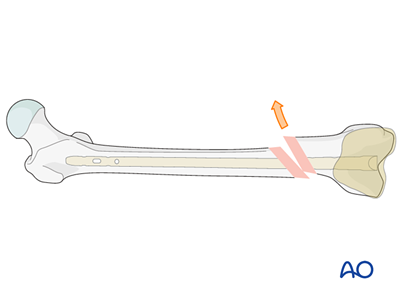 Retrograde nailing for Fracture proximal to the femoral component