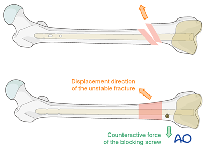 Retrograde nailing for Fracture proximal to the femoral component
