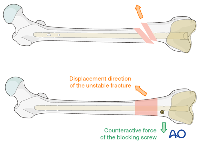 Retrograde nailing for Fracture proximal to the femoral component