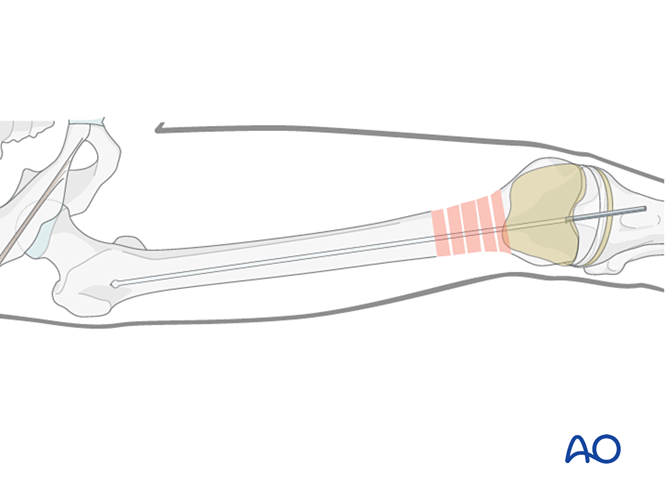 Retrograde nailing for Fracture proximal to the femoral component