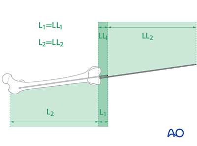 Retrograde nailing for Fracture proximal to the femoral component