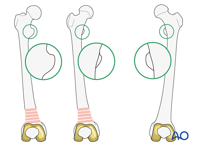 Retrograde nailing for Fracture proximal to the femoral component