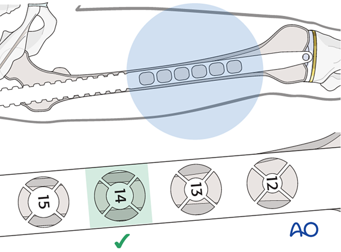 Retrograde nailing for Fracture proximal to the femoral component