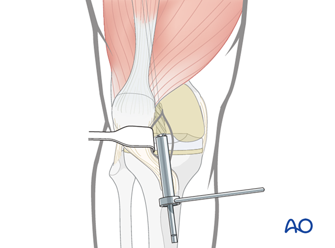 Retrograde nailing for Fracture proximal to the femoral component