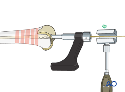 Retrograde nailing for Fracture proximal to the femoral component