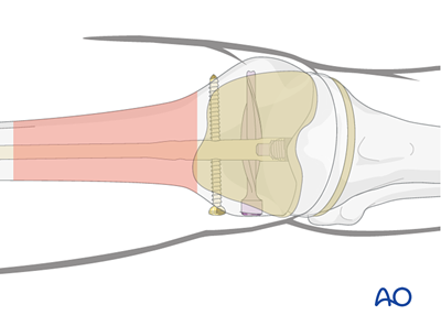 Retrograde nailing for Fracture proximal to the femoral component