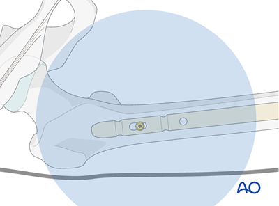 Retrograde nailing for Fracture proximal to the femoral component