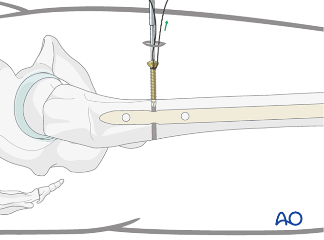 Retrograde nailing for Fracture proximal to the femoral component
