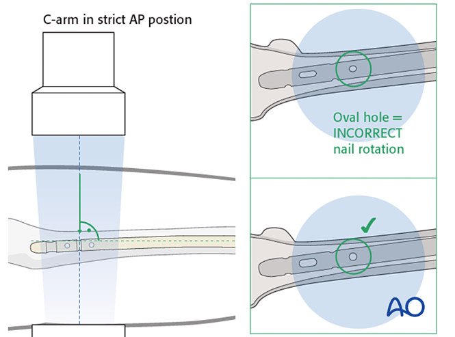 Retrograde nailing for Fracture proximal to the femoral component