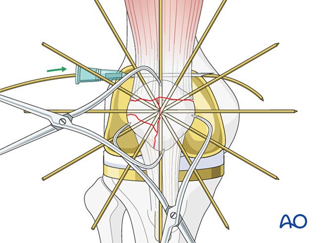 Cerclage wire for Fracture around stable patellar component and good ...