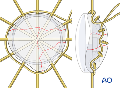 Cerclage wire for Fracture around stable patellar component and good ...
