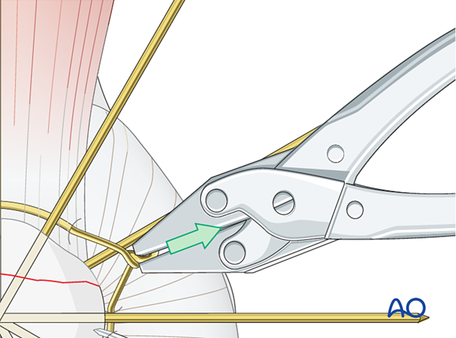 Cerclage wire for Fracture around stable patellar component and good ...
