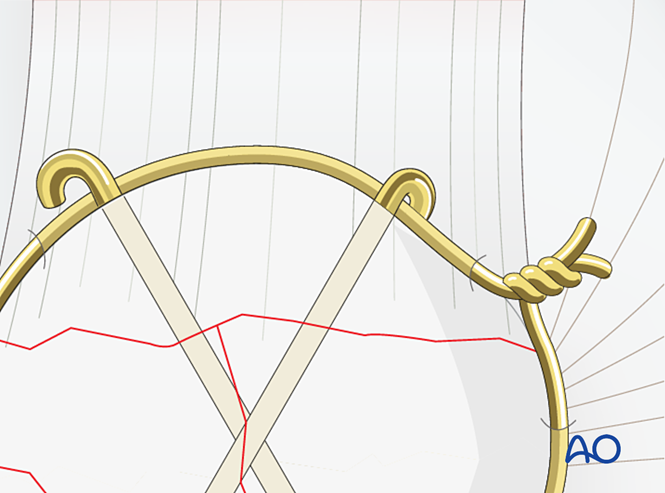 Cerclage wire for Fracture around stable patellar component and good ...