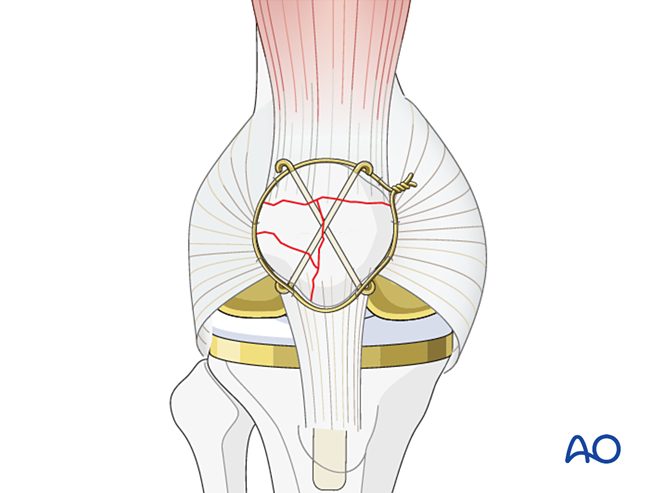 Cerclage wire for Fracture around stable patellar component and good ...