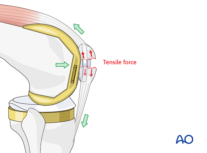 Tension band wire for Fracture around stable patellar component and ...