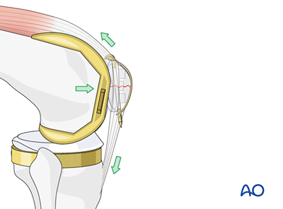 Tension band wire for Fracture around stable patellar component and ...