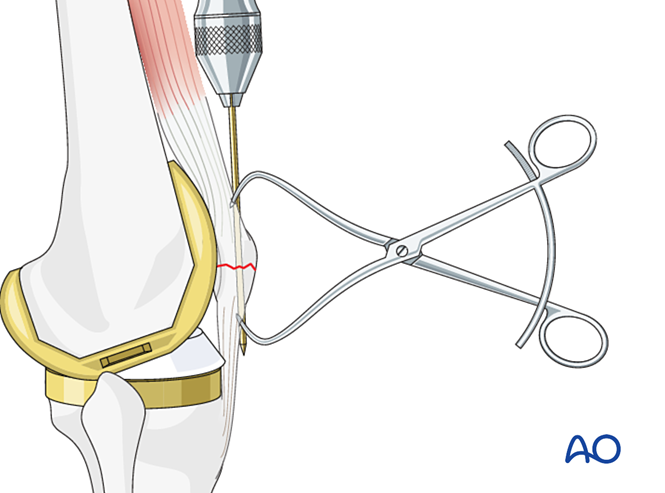 Tension band wire for Fracture around stable patellar component and ...