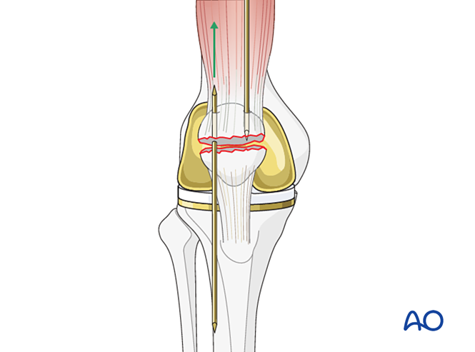Tension band wire for Fracture around stable patellar component and ...