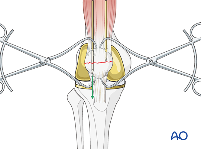 Tension band wire for Fracture around stable patellar component and ...
