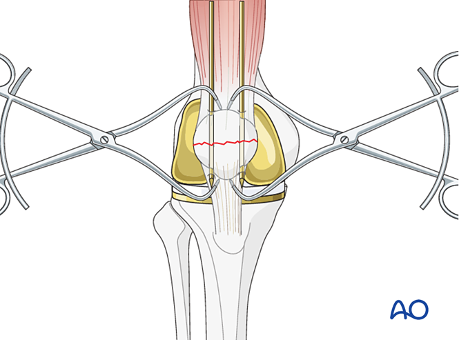 Tension band wire for Fracture around stable patellar component and ...