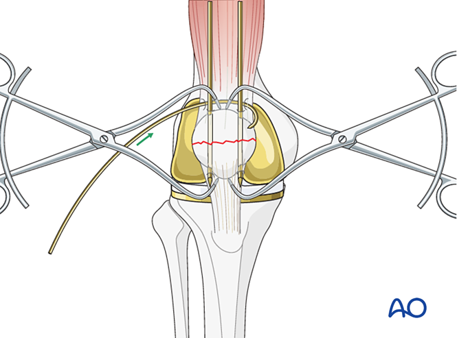 Tension band wire for Fracture around stable patellar component and ...