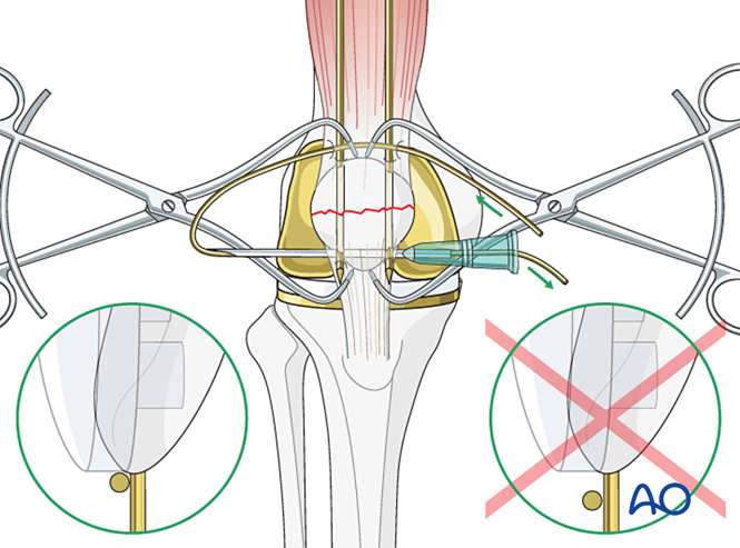 Tension band wire for Fracture around stable patellar component and ...