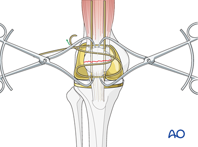 Tension band wire for Fracture around stable patellar component and ...