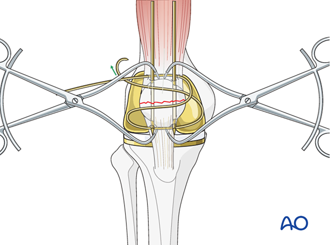 Tension band wire for Fracture around stable patellar component and ...
