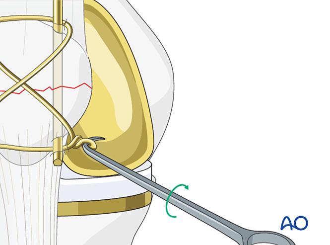 Tension band wire for Fracture around stable patellar component and ...
