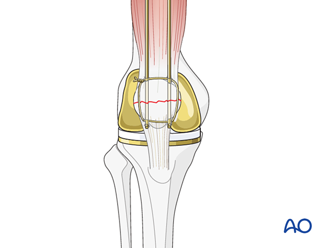 Tension band wire for Fracture around stable patellar component and ...