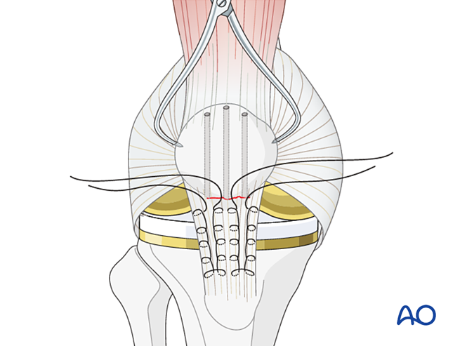 Suture repair for Disrupted extensor mechanism