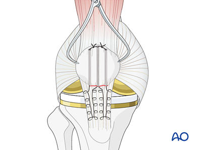 Suture repair for Disrupted extensor mechanism