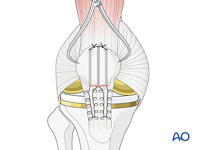 Suture repair for Disrupted extensor mechanism