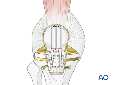 Suture repair for Disrupted extensor mechanism