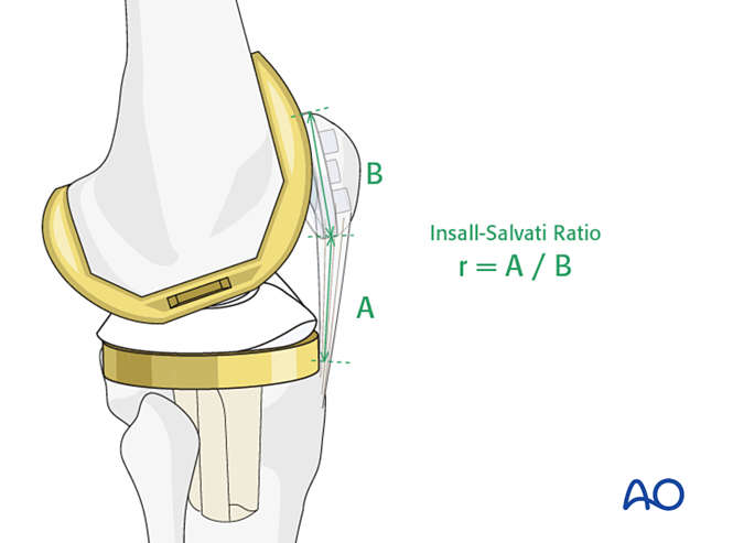 Suture repair for Disrupted extensor mechanism