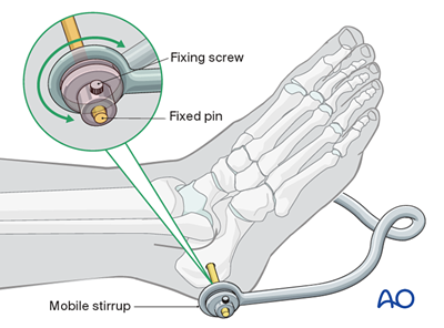 Traction for Fracture around a stable tibial component with good bone stock