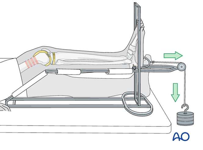 Traction for Fracture around a stable femoral component with good bone ...