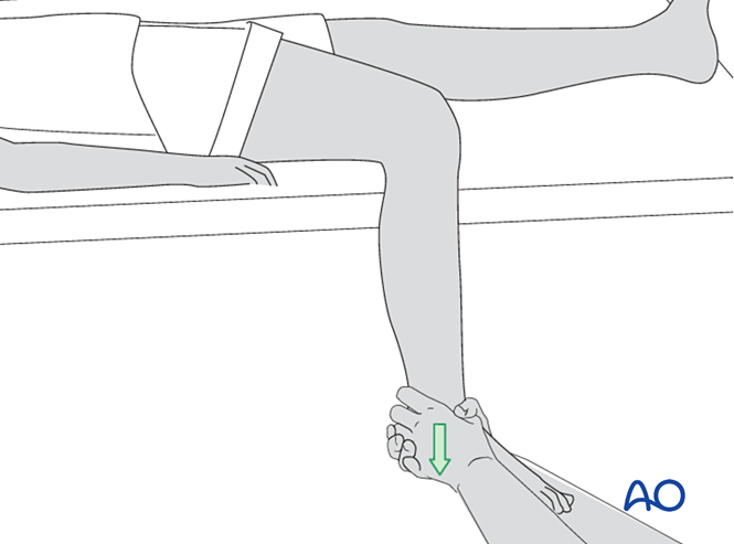 Splint or plaster for Fracture around a stable tibial component with ...