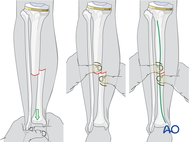 Splint or plaster for Fracture distal to the tibial component and ...