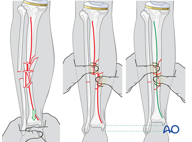 Splint or plaster for Fracture around a stable tibial component with ...