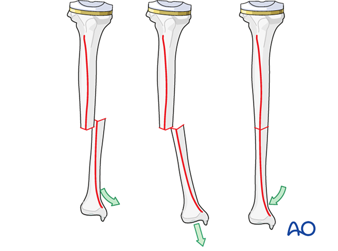 Splint or plaster for Fracture around a stable tibial component with ...