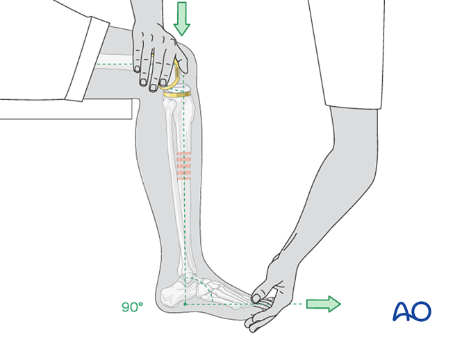 Splint or plaster for Nondisplaced tibial plateau or tubercle fracture