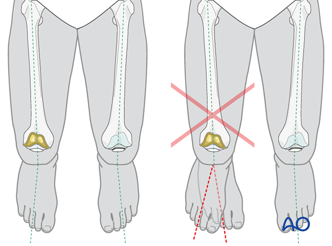 Splint or plaster for Nondisplaced tibial plateau or tubercle fracture
