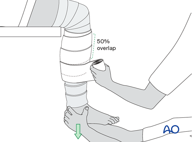 Splint or plaster for Nondisplaced tibial plateau or tubercle fracture