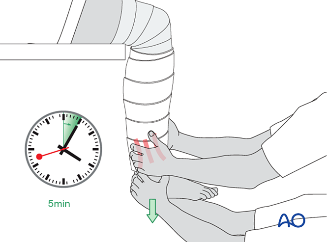 Splint or plaster for Nondisplaced tibial plateau or tubercle fracture