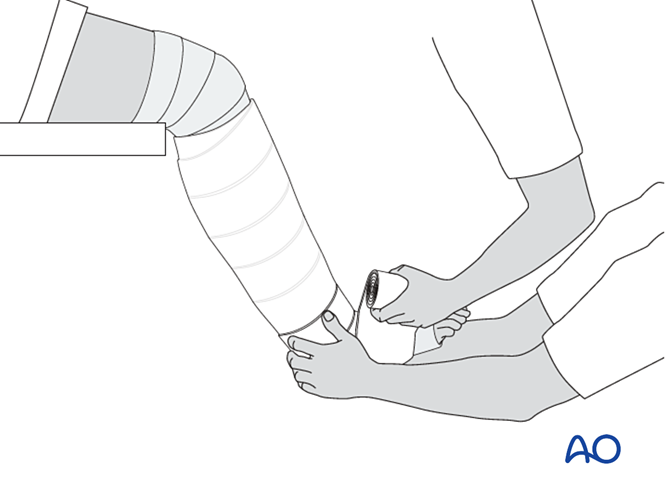 Splint or plaster for Fracture around a loose tibial component with ...
