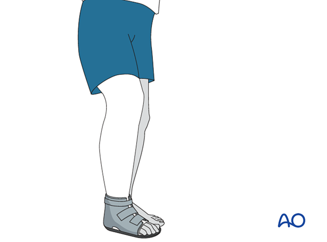 Splint or plaster for Fracture around a stable tibial component with ...