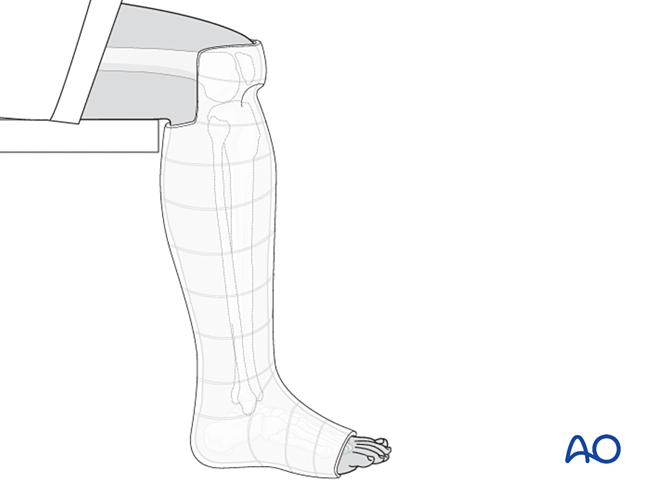 Splint or plaster for Fracture distal to the tibial component and ...
